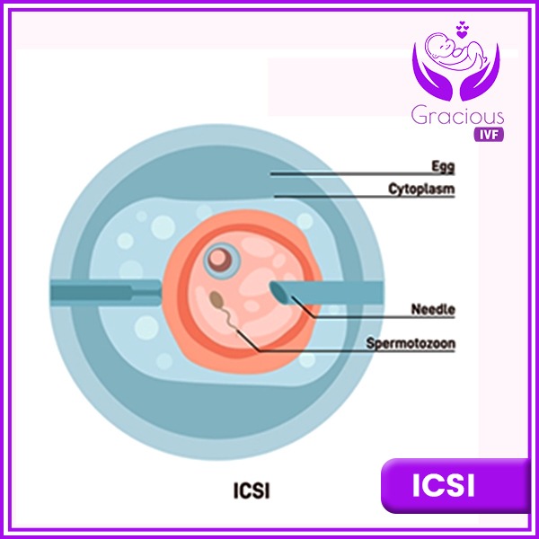 Intracytoplasmic Sperm Injection Treatment - Gracious IVF